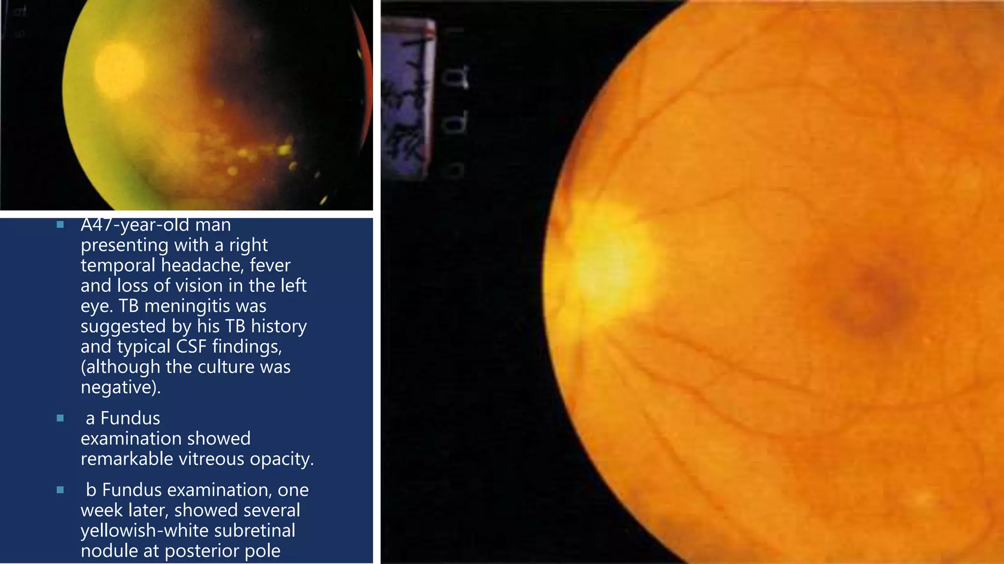 Ocular Manifestations of Tuberculosis | PPTX
