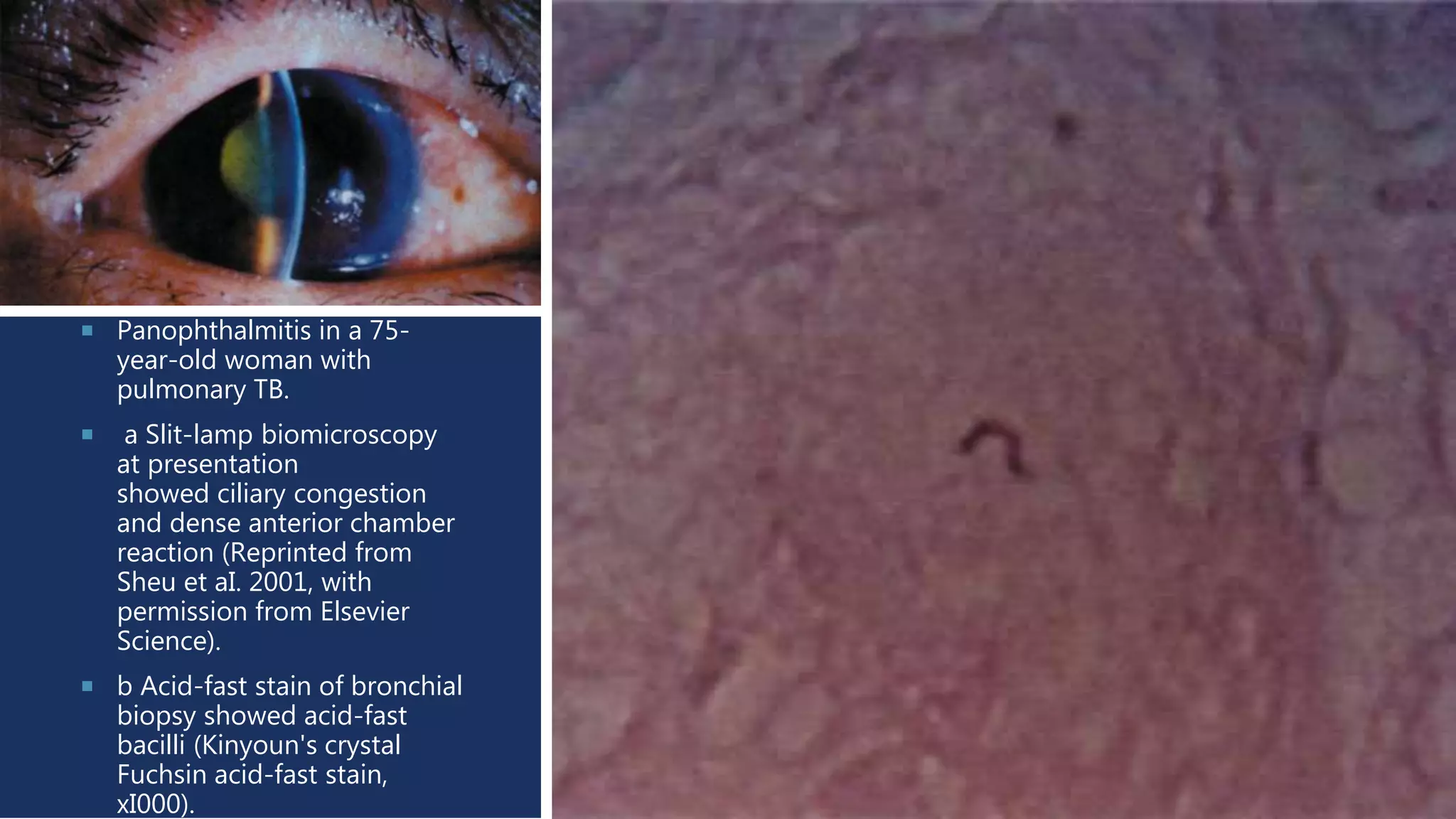 Ocular Manifestations of Tuberculosis | PPTX