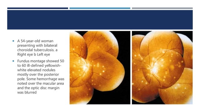 Ocular Manifestations of Tuberculosis | PPTX