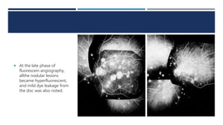 Ocular Manifestations of Tuberculosis | PPTX
