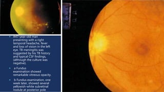 Ocular Manifestations of Tuberculosis | PPTX