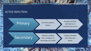 Ocular Manifestations of Tuberculosis | PPTX
