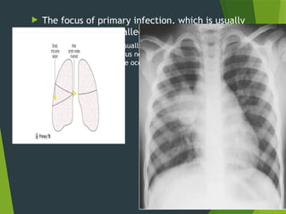 Tuberculosis For HOC1.pptx pulmonary and extrapulmonary | PPTX