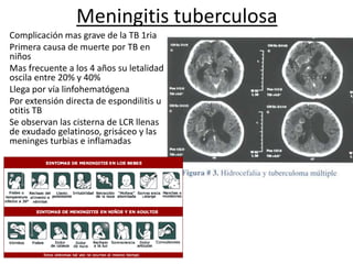 Tuberculosis formas clinicas | PPTX