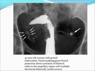 Tuberculosis genital | PPT