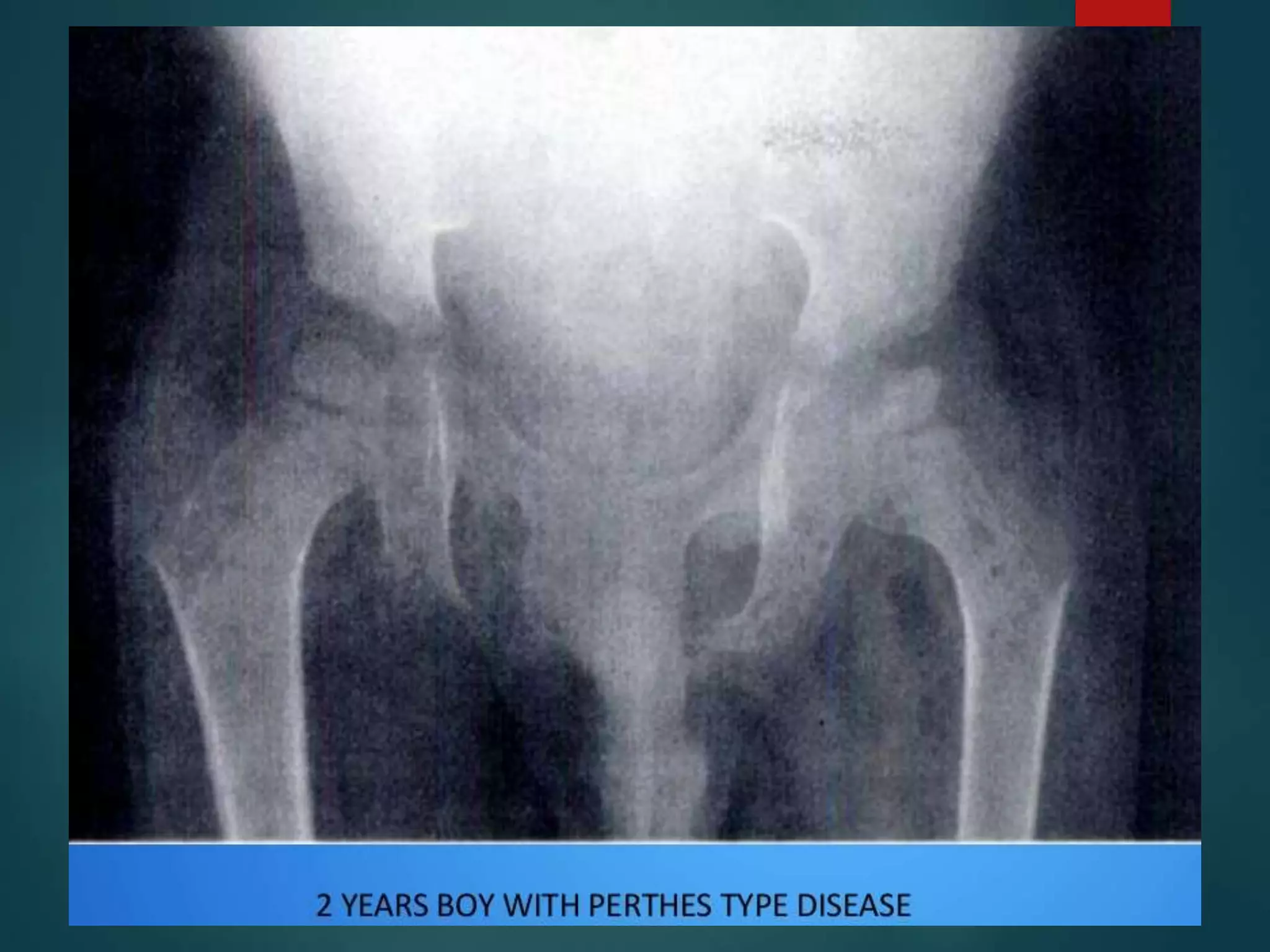 Tuberculosis of Hip Joint | PPT