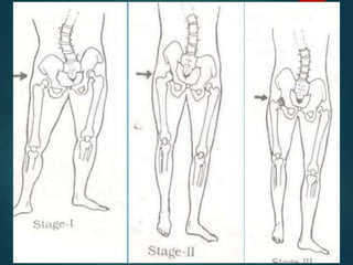 Tuberculosis of Hip Joint | PPT
