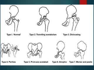 Tuberculosis of Hip Joint | PPT