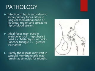 Tuberculosis of Hip Joint | PPT