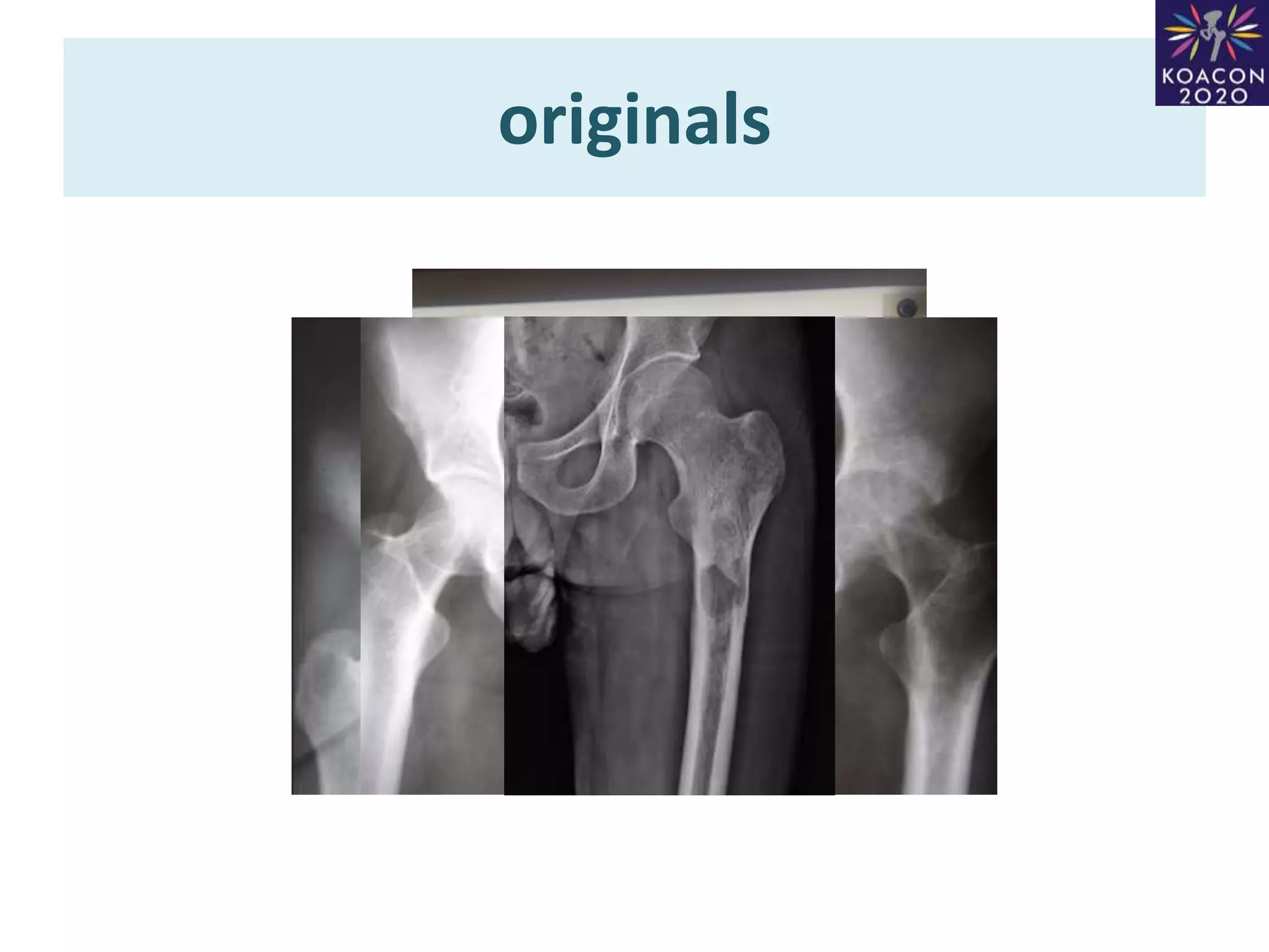 Tuberculosis hip and TB like lesions dr mohamed ashraf -HOD-govt TD ...
