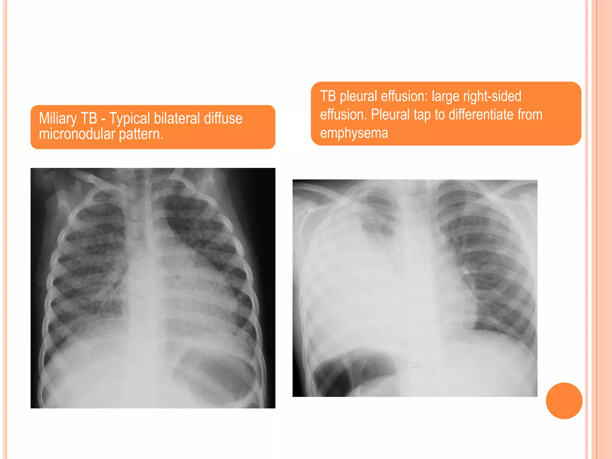Tuberculosis in children-1.pptx