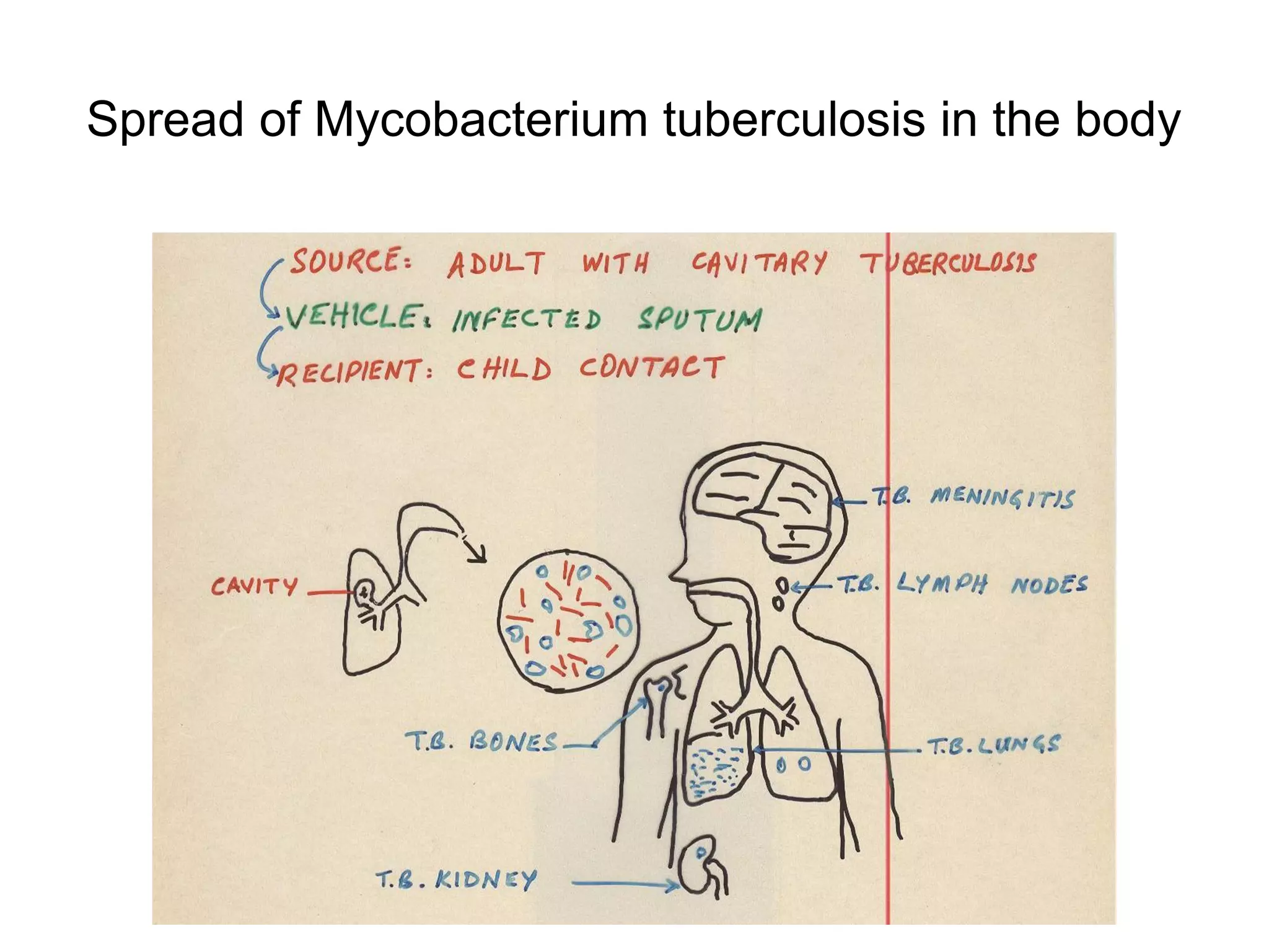 Tuberculosis in children 2021 | PDF