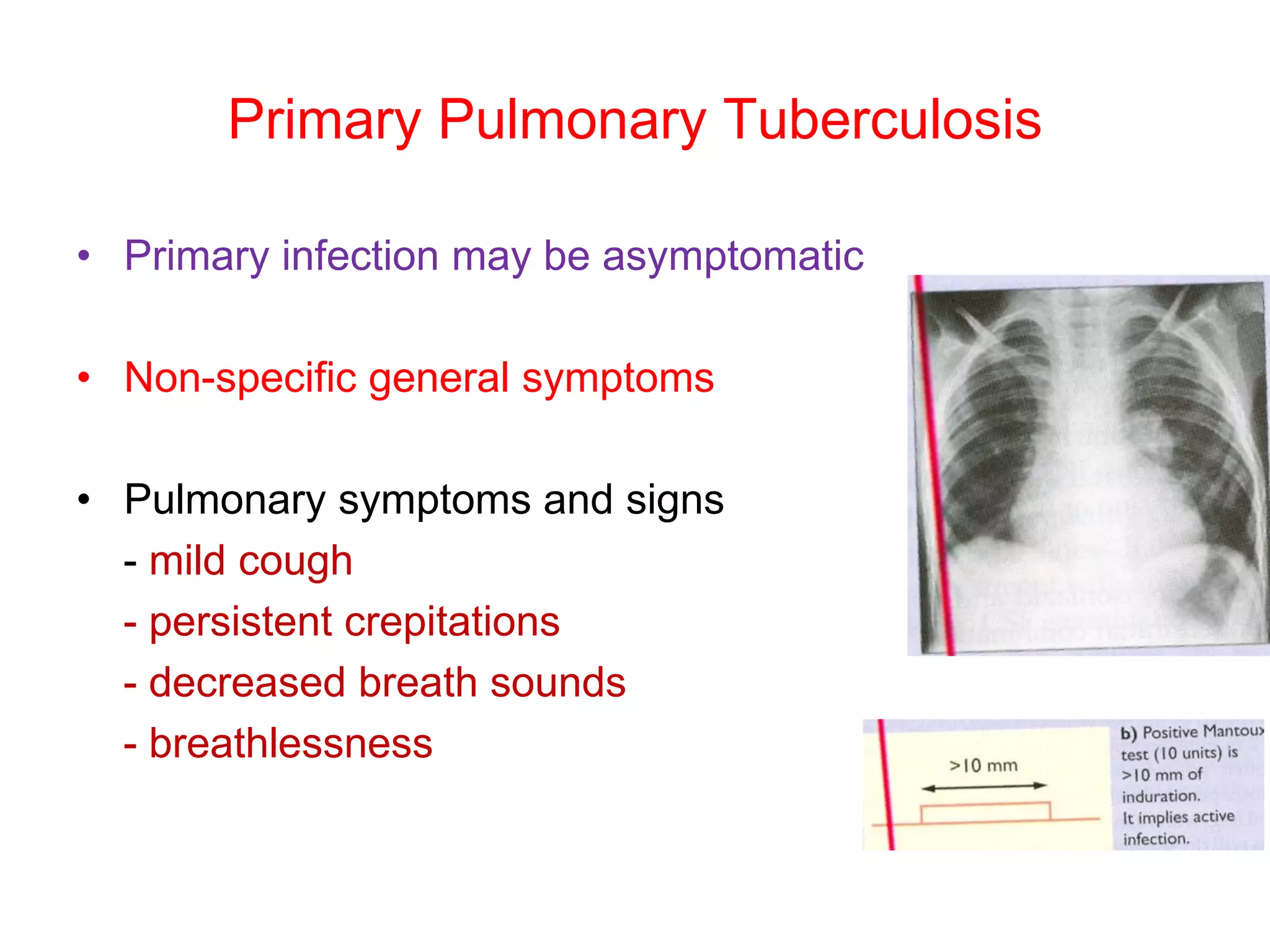 Tuberculosis in children 2021 | PDF