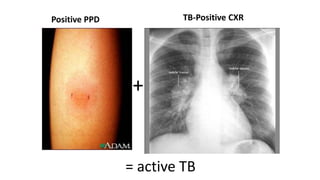 Tuberculosis in pediatric age group | PPT