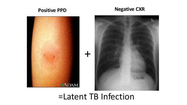 Tuberculosis in pediatric age group