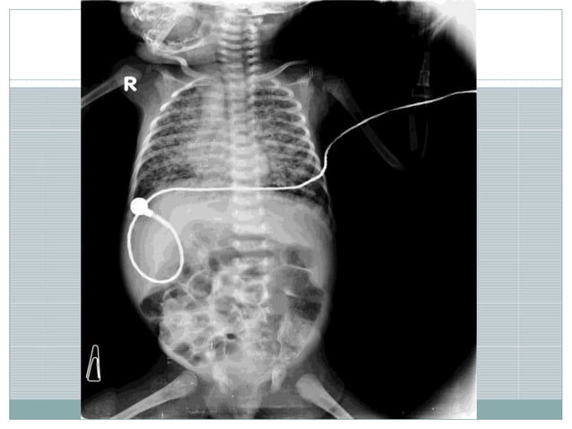 Tuberculosis in pregnancy | PPTX | Pregnancy | Reproductive Health