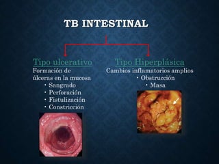 Tuberculosis intestinal | PPTX