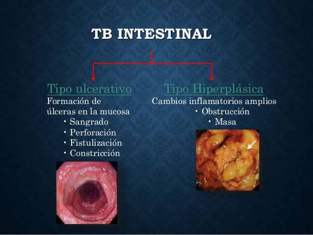 Tuberculosis intestinal