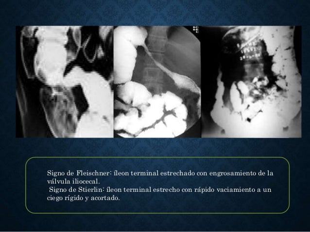 Tuberculosis intestinal