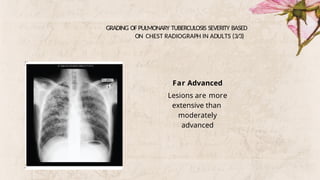Tuberculosis kogi copy.pptxgfhnfgbftyrtghbcxt | PPTX | Lung and ...