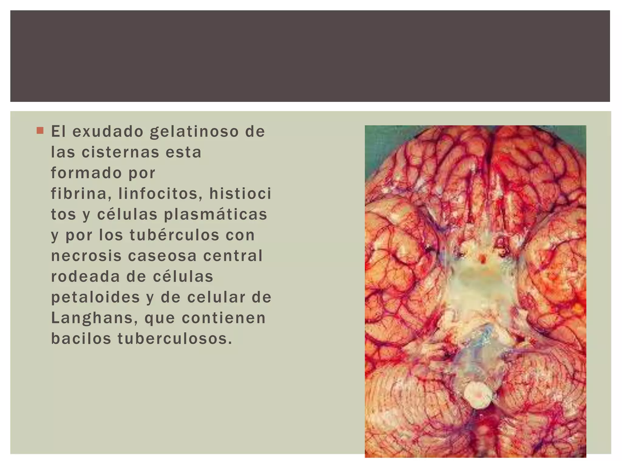 Tuberculosis meningea | PPTX