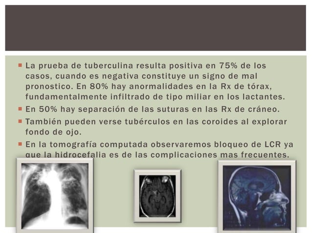 Tuberculosis meningea | PPTX