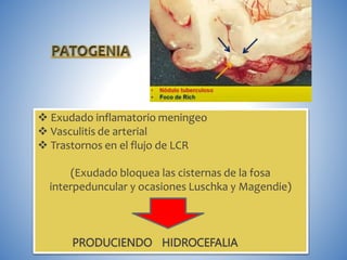 TUBERCULOSIS MENINGEA.pptx