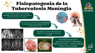 TUBERCULOSIS MENINGIA medicina patologia .pdf