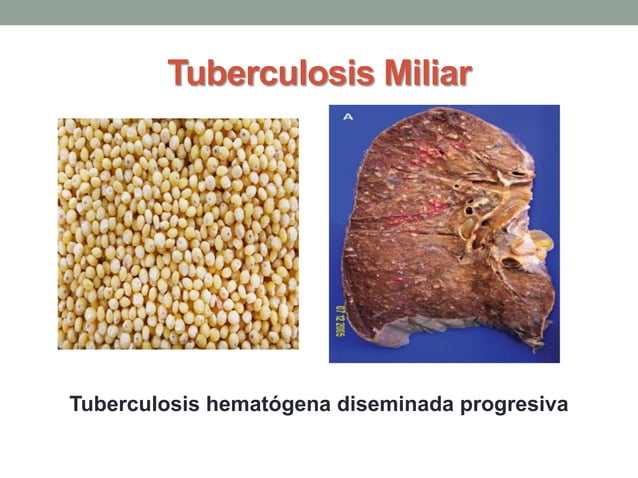 Tuberculosis miliar | PPT