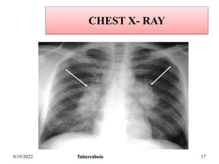 tuberculosis (MSN).pptx