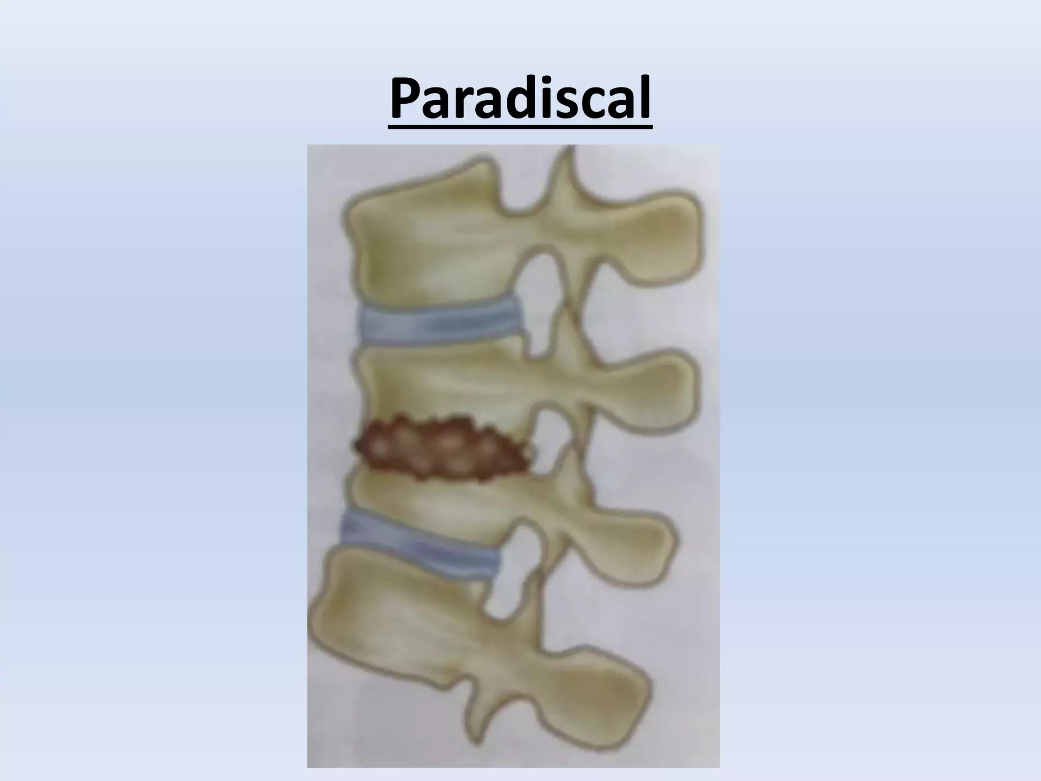 Tuberculosis of bone and joints | PPTX
