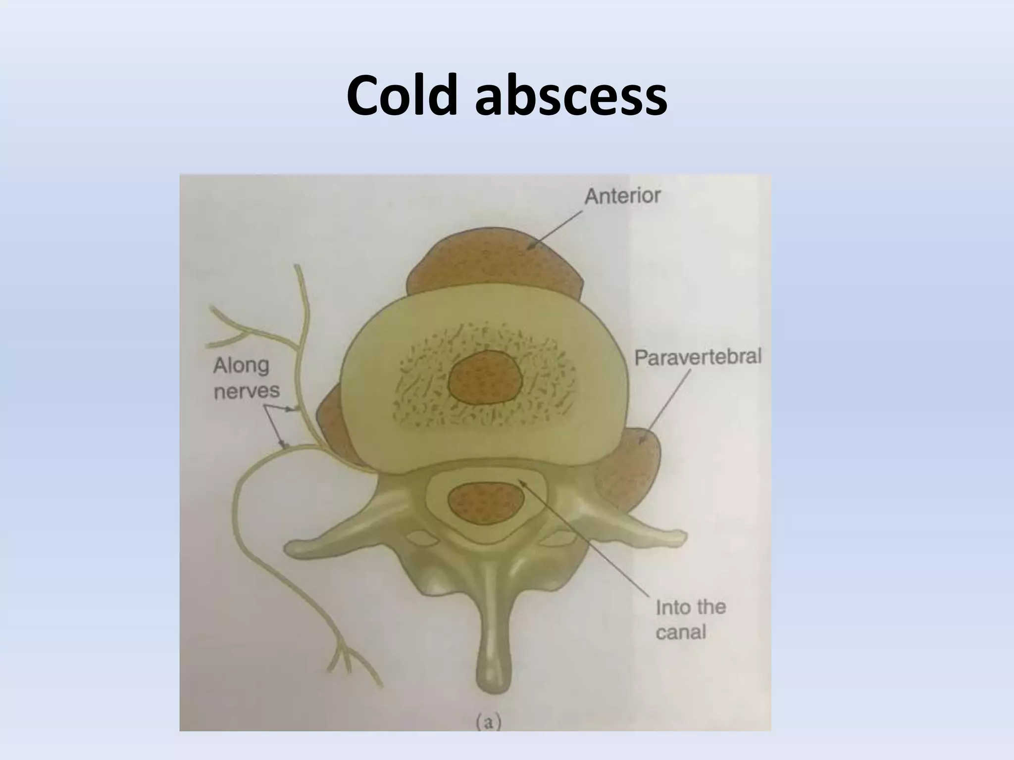 Tuberculosis of bone and joints | PPTX