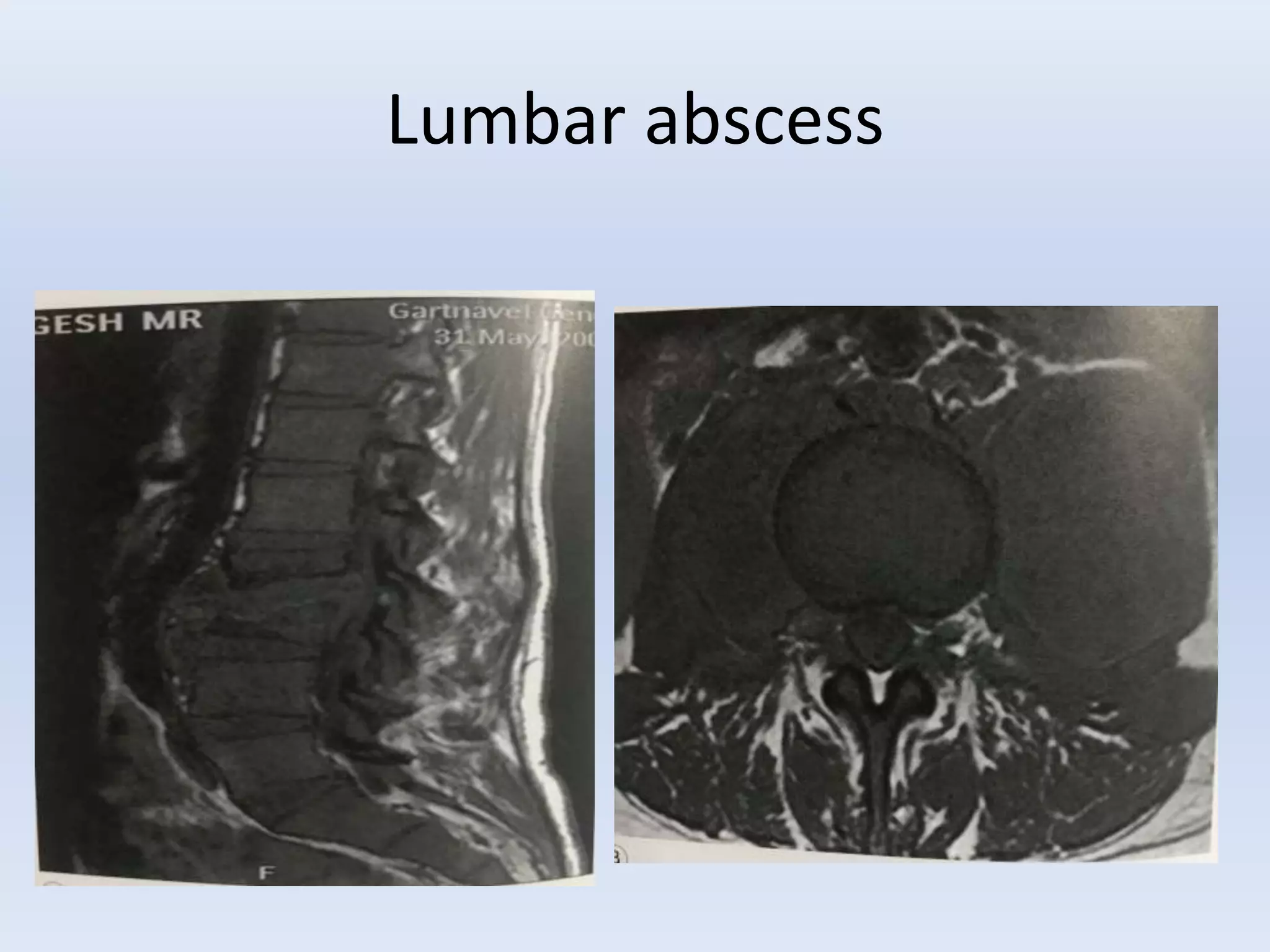Tuberculosis of bone and joints | PPTX