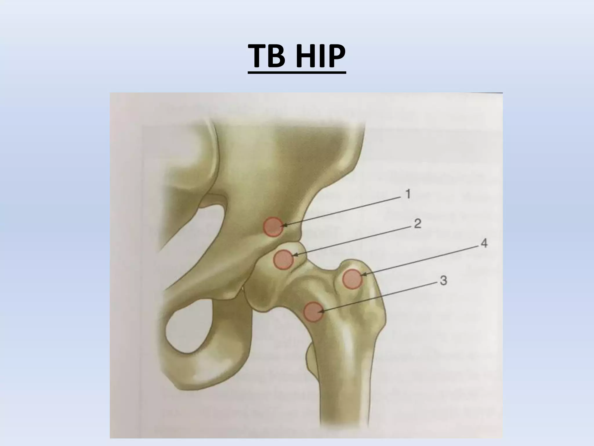 Tuberculosis of bone and joints | PPTX