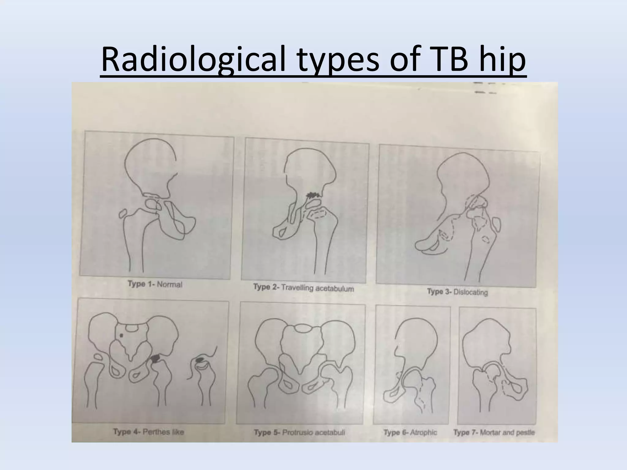 Tuberculosis of bone and joints | PPTX