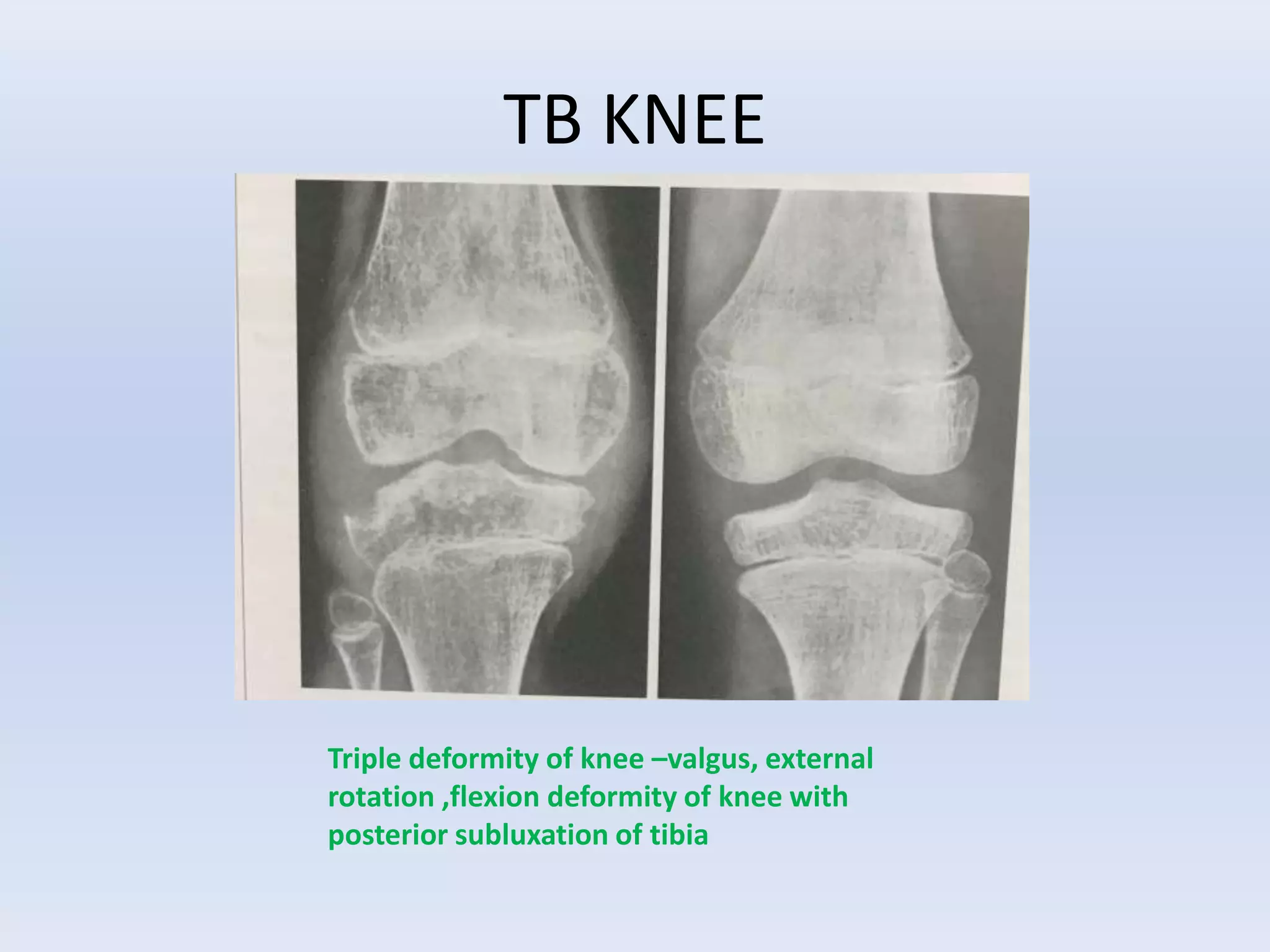 Tuberculosis of bone and joints | PPTX