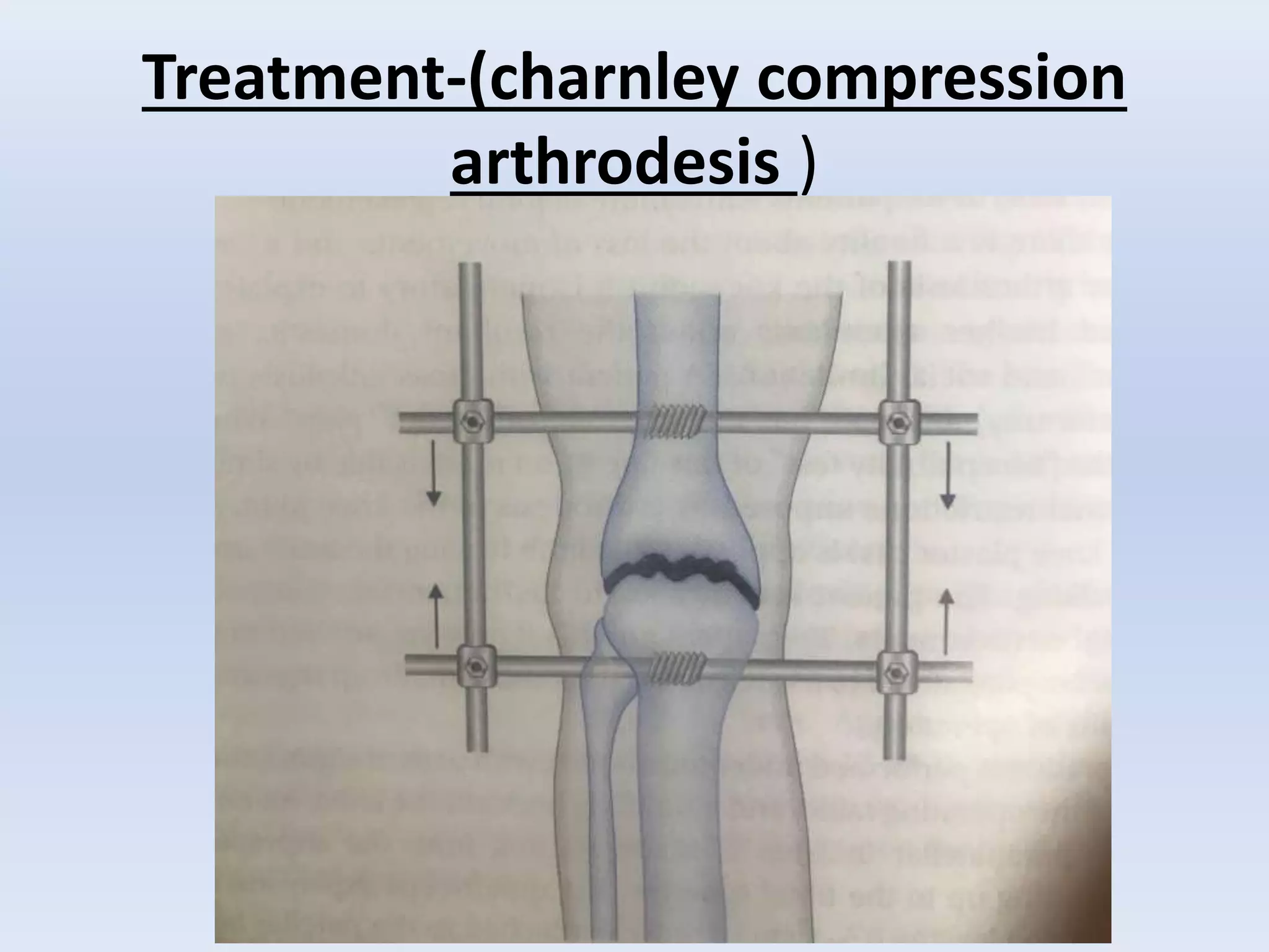 Tuberculosis of bone and joints | PPTX