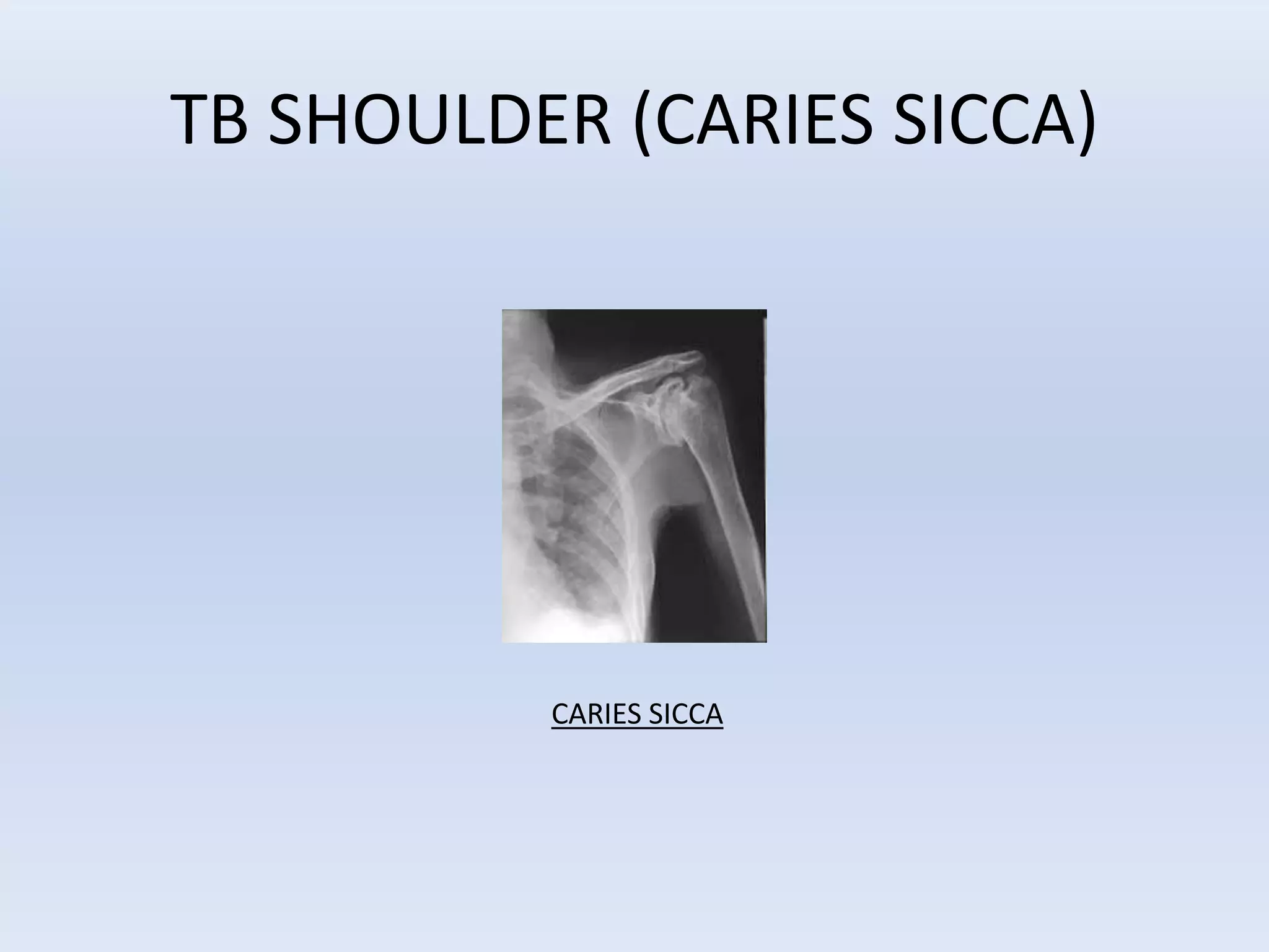 Tuberculosis of bone and joints | PPTX