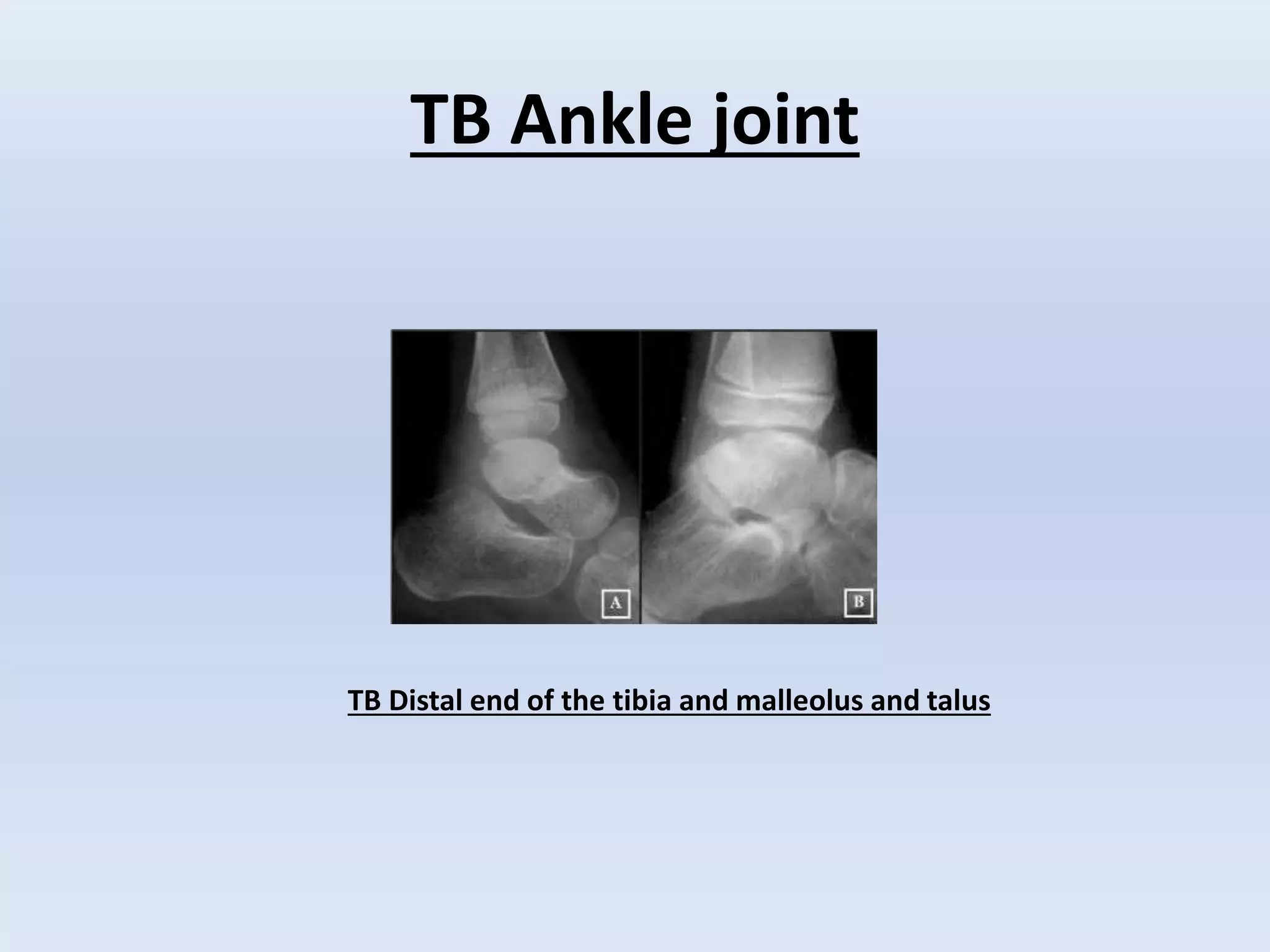 Tuberculosis of bone and joints | PPTX