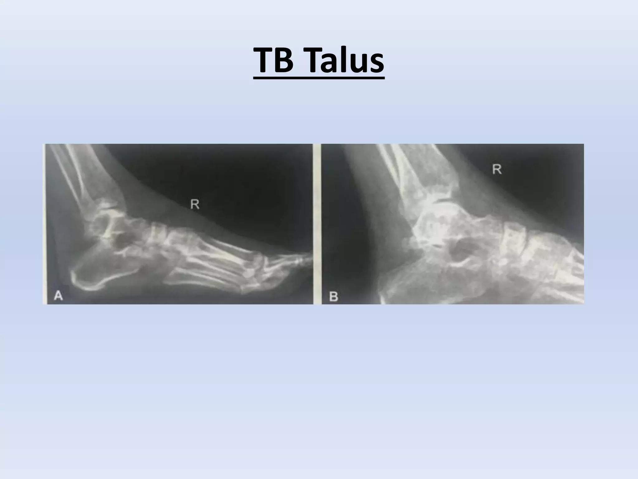 Tuberculosis of bone and joints | PPTX