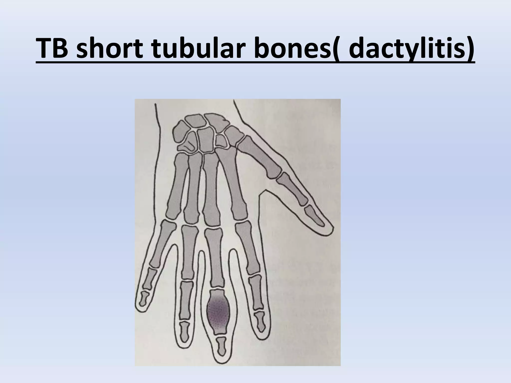 Tuberculosis of bone and joints | PPTX