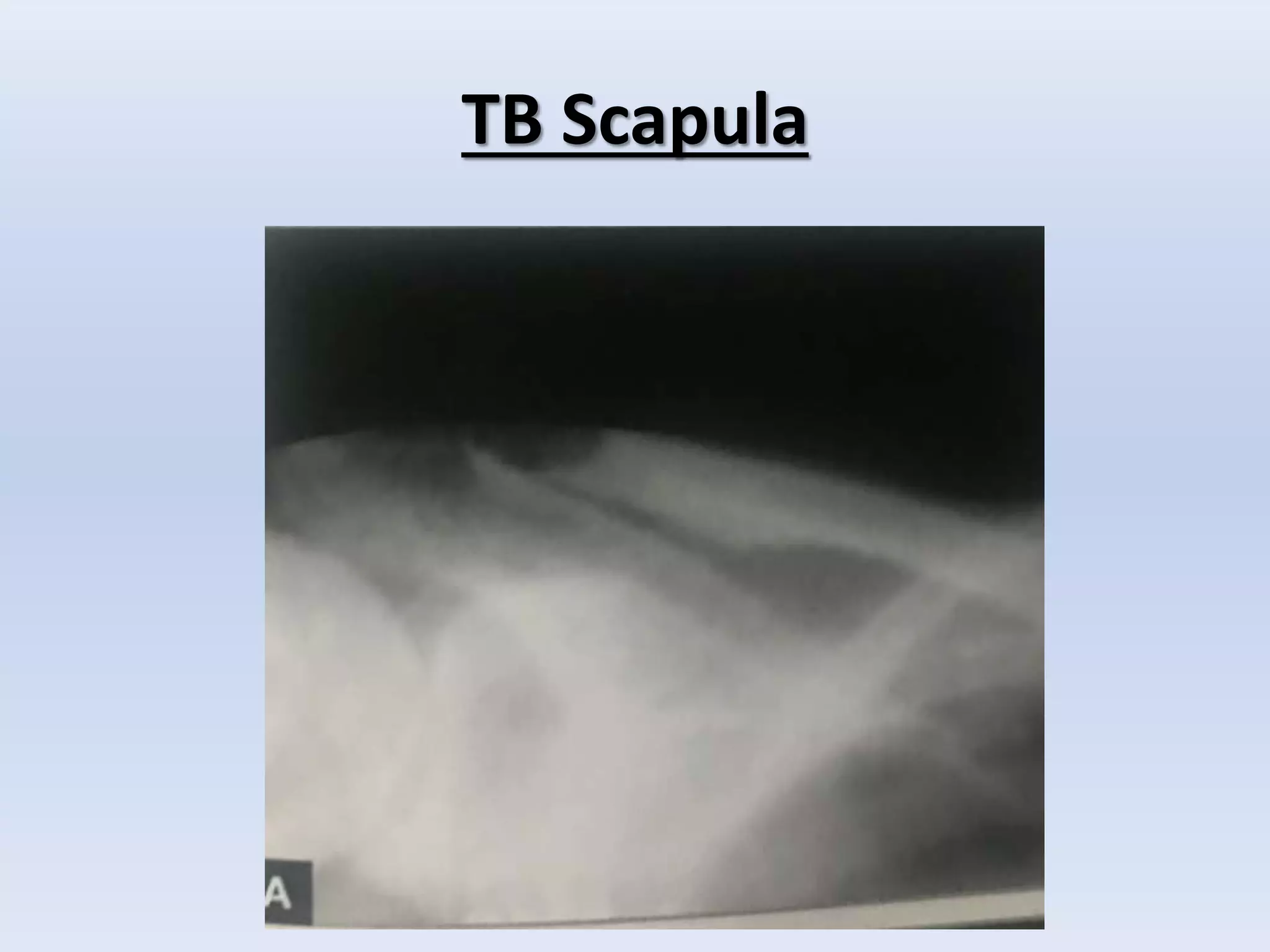Tuberculosis of bone and joints | PPTX