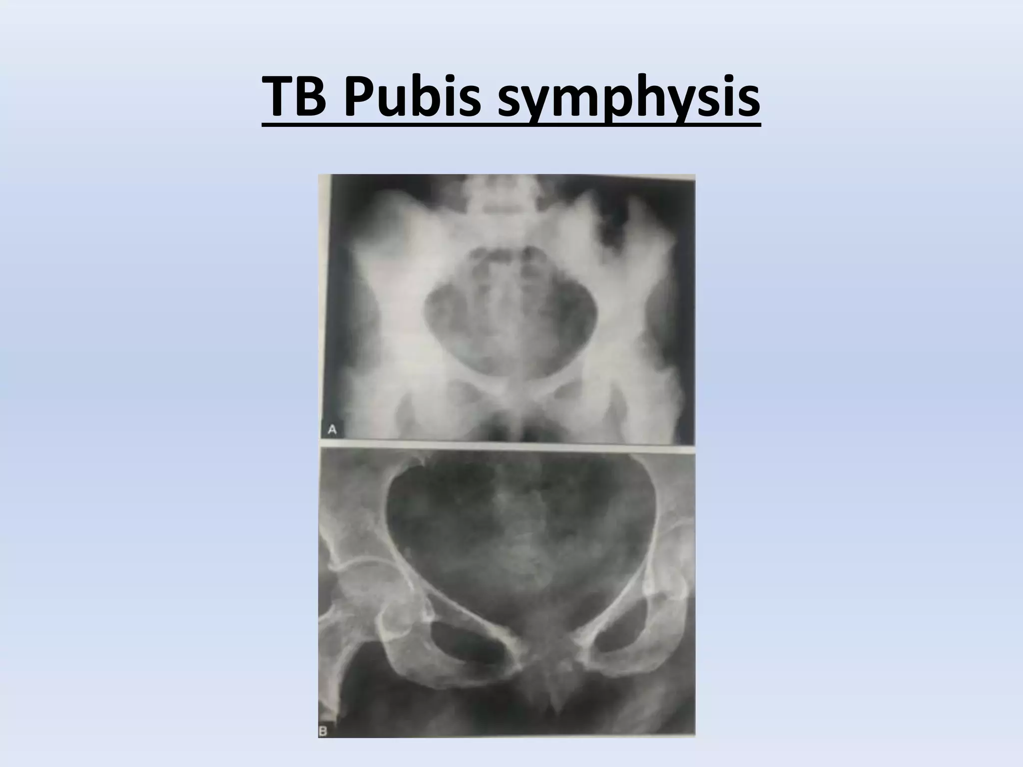 Tuberculosis of bone and joints | PPTX