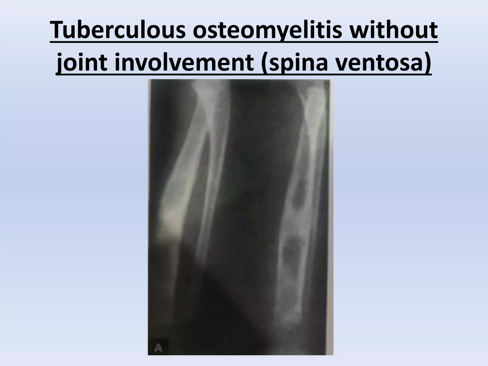 Tuberculosis of bone and joints | PPT | Free Download