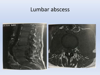 Tuberculosis of bone and joints | PPTX
