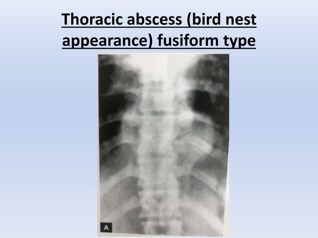 Tuberculosis of bone and joints | PPTX