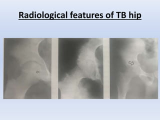 Tuberculosis of bone and joints | PPTX