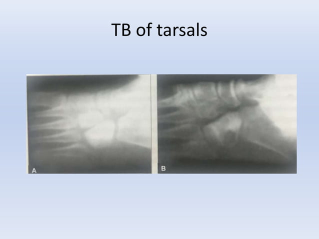 Tuberculosis of bone and joints | PPTX