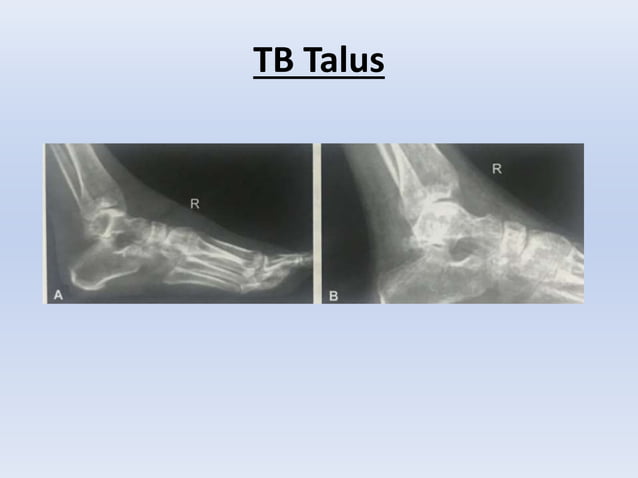 Tuberculosis of bone and joints | PPTX