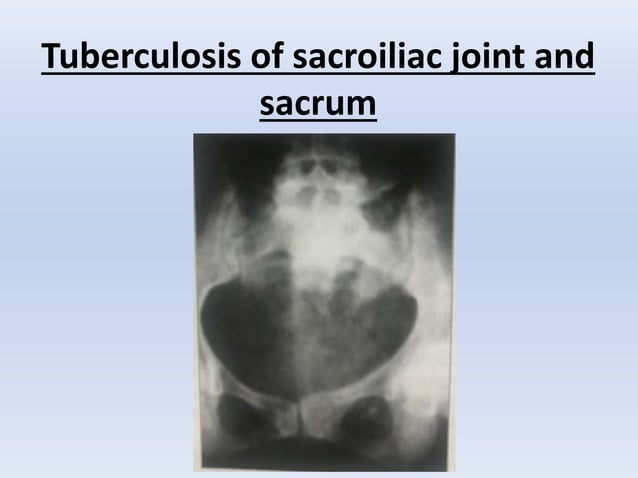 Tuberculosis of bone and joints | PPTX